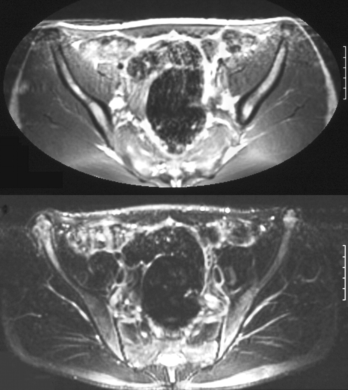 “Goalkeeper’s hip”: acute haematogenous osteomyelitis secondary to ...