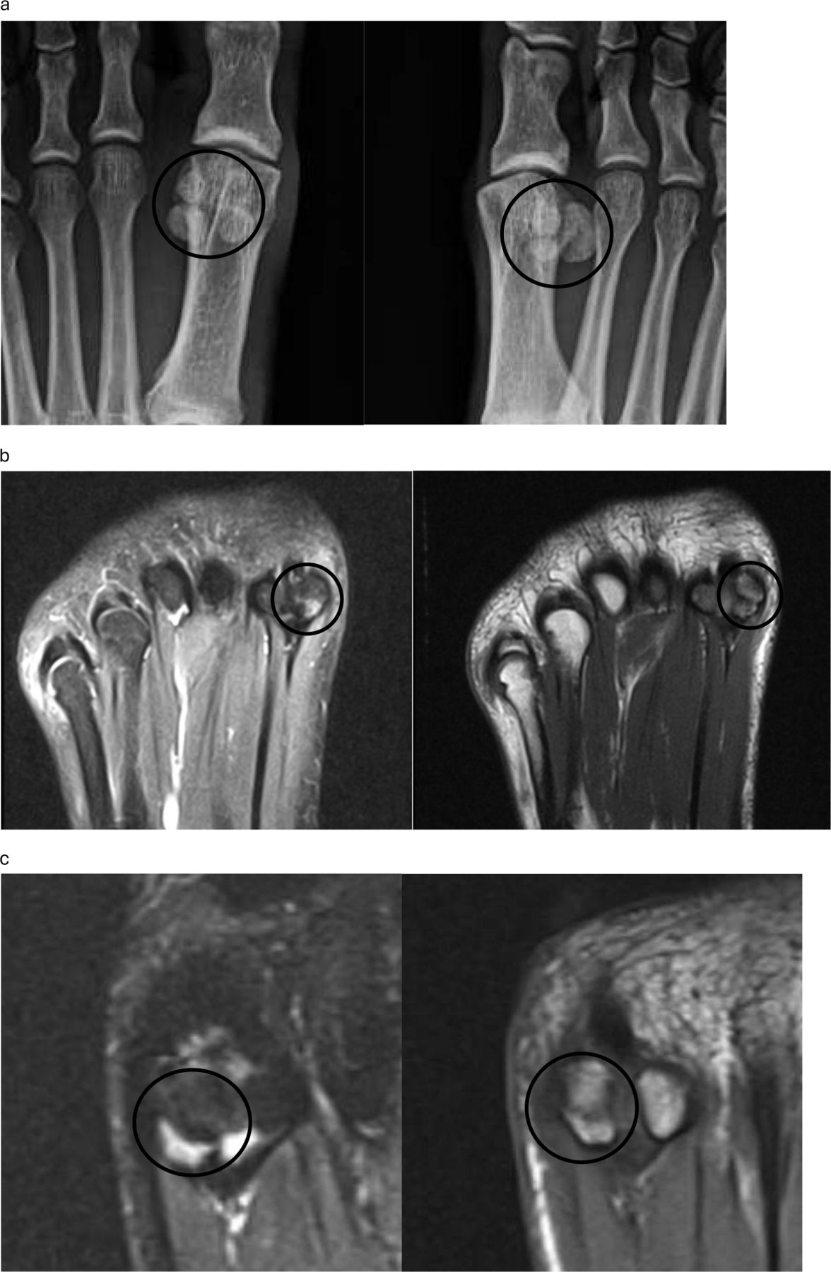 Sesamoid bone stress injury: revising the diagnostic framework for ...